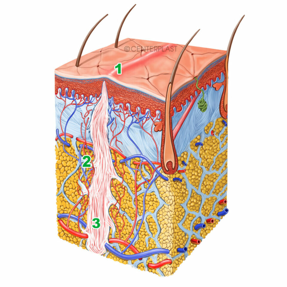 Scar correction in Saarbrücken | CenterPlast